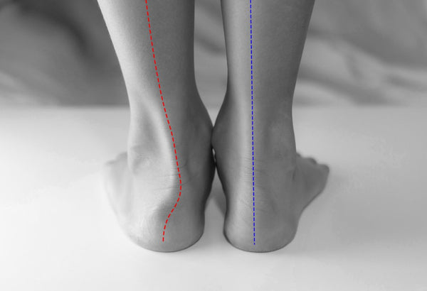 Pronation: Causes, Effects, Footwear & Exercises for Foot Pain Relief ...